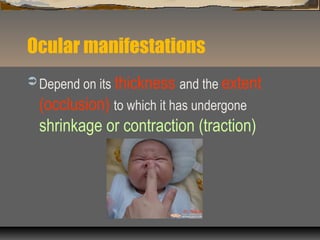 NW2010 Epiretinal membrane | PPT