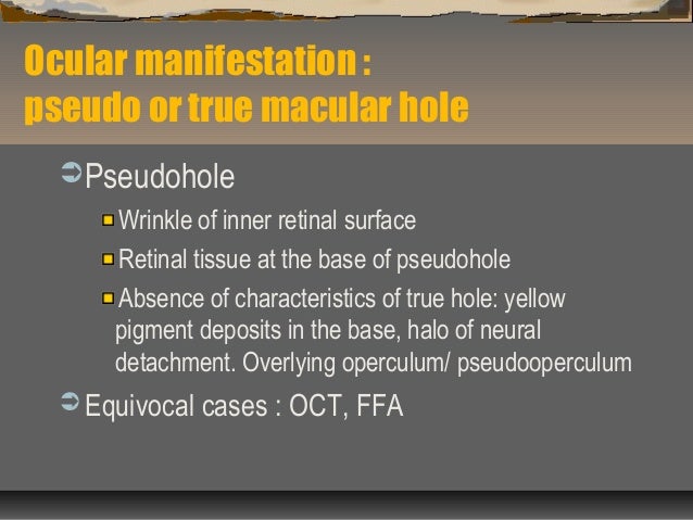 Epiretinal Membrane Pseudohole