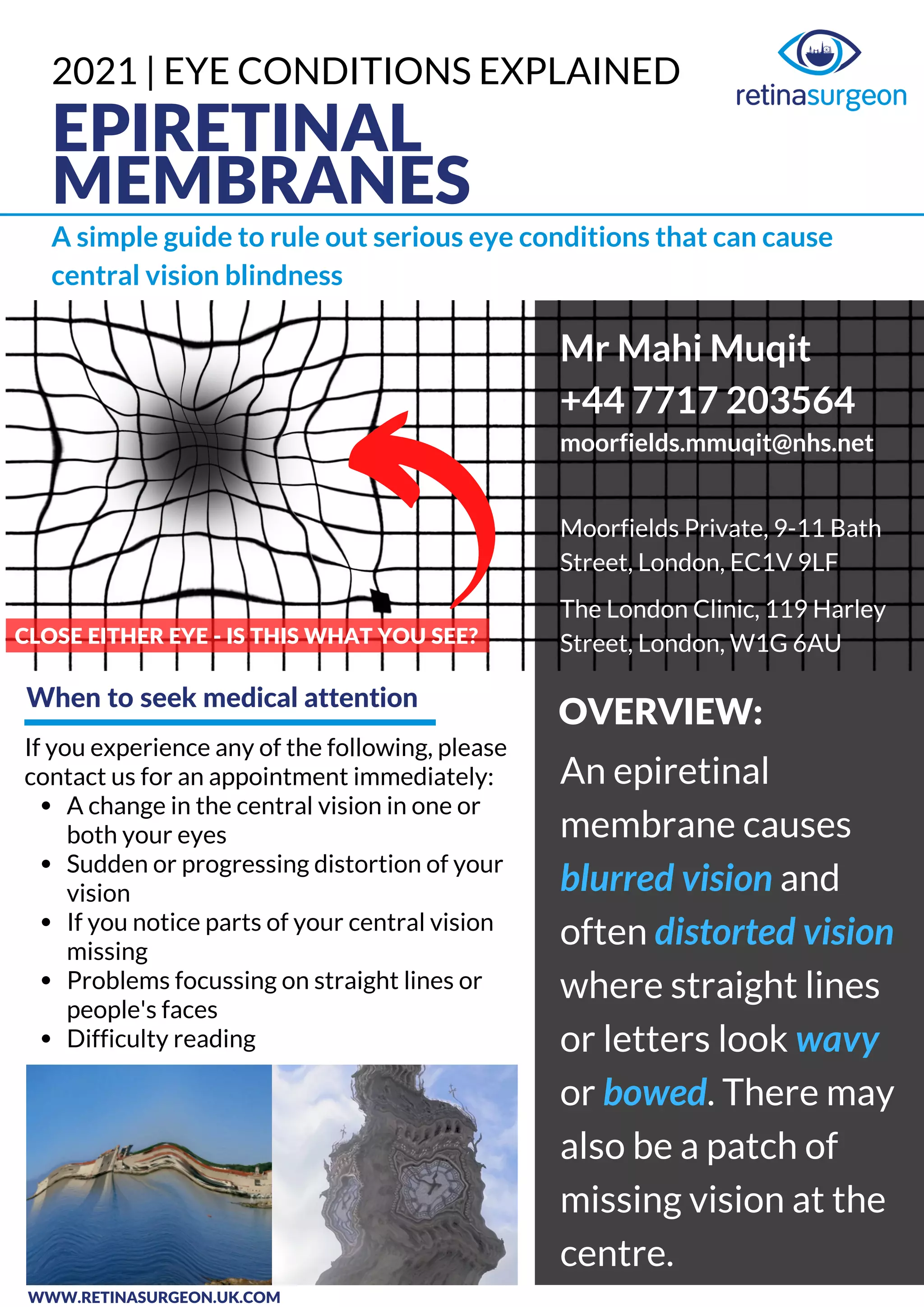 Epiretinal membranes 2021 | PDF