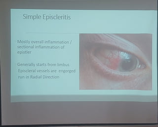 Episcleritis, scleritis, ophthalmology.pdf