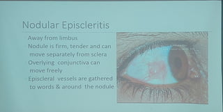 Episcleritis, scleritis, ophthalmology.pdf