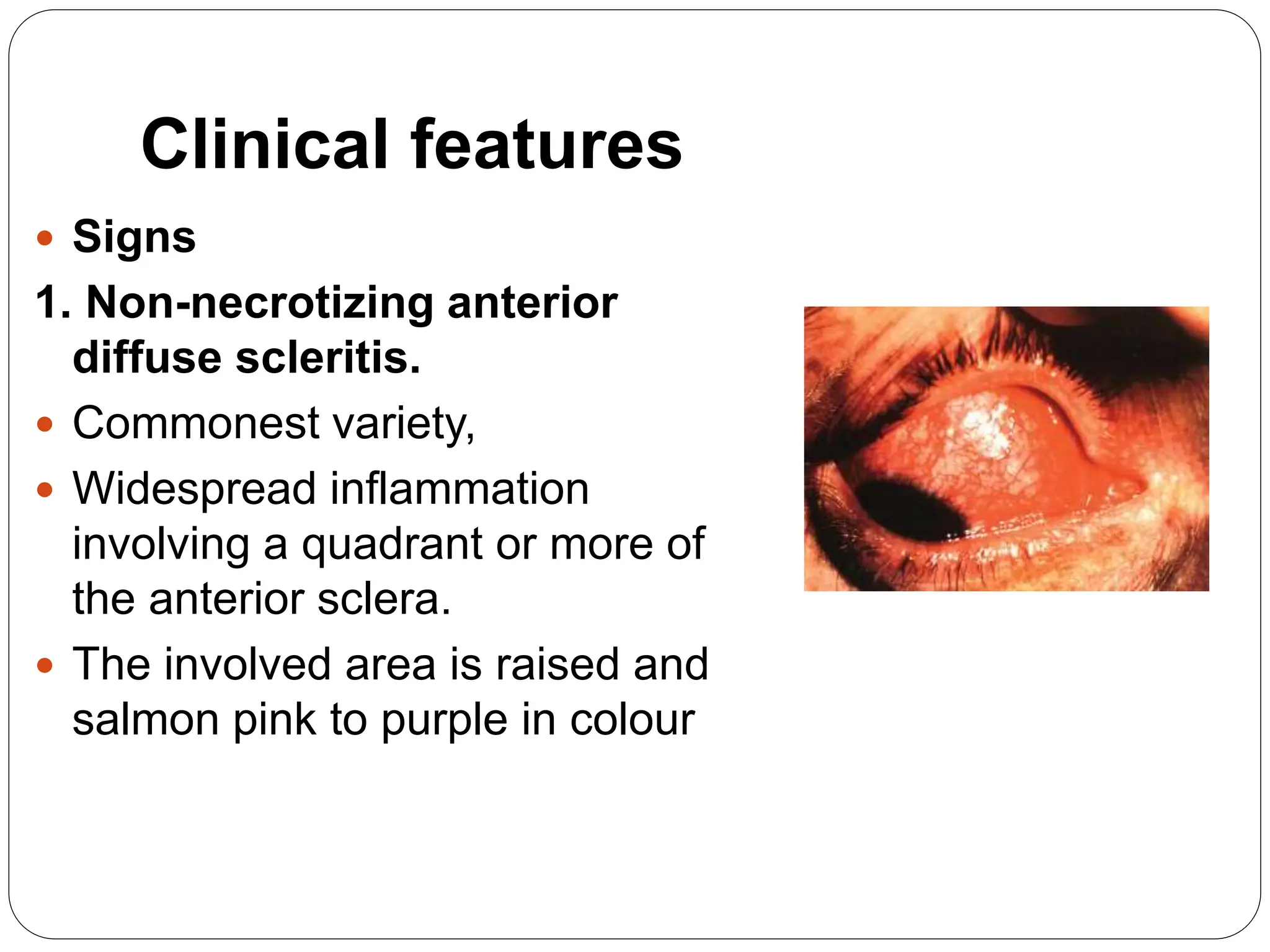 Episcleritis and Scleritis power point presentations | PPTX