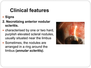 Episcleritis and Scleritis power point presentations | PPTX