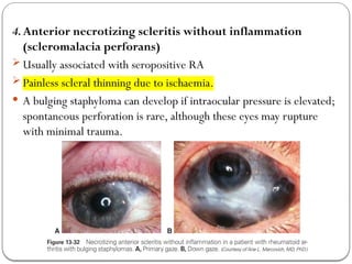 Episcleritis and Scleritis etiology and management | PPTX