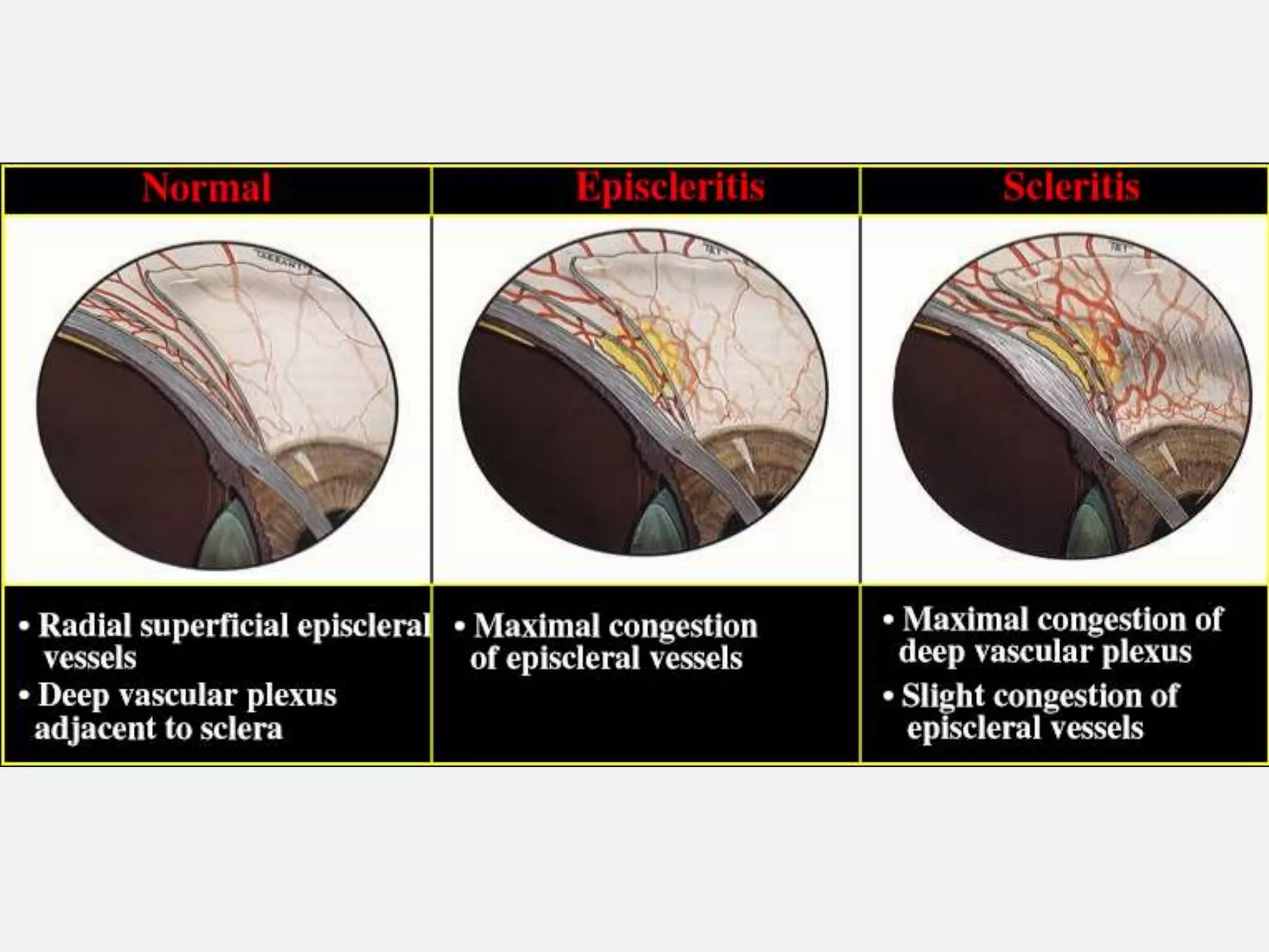 Episcleritis and scleritis | PPTX