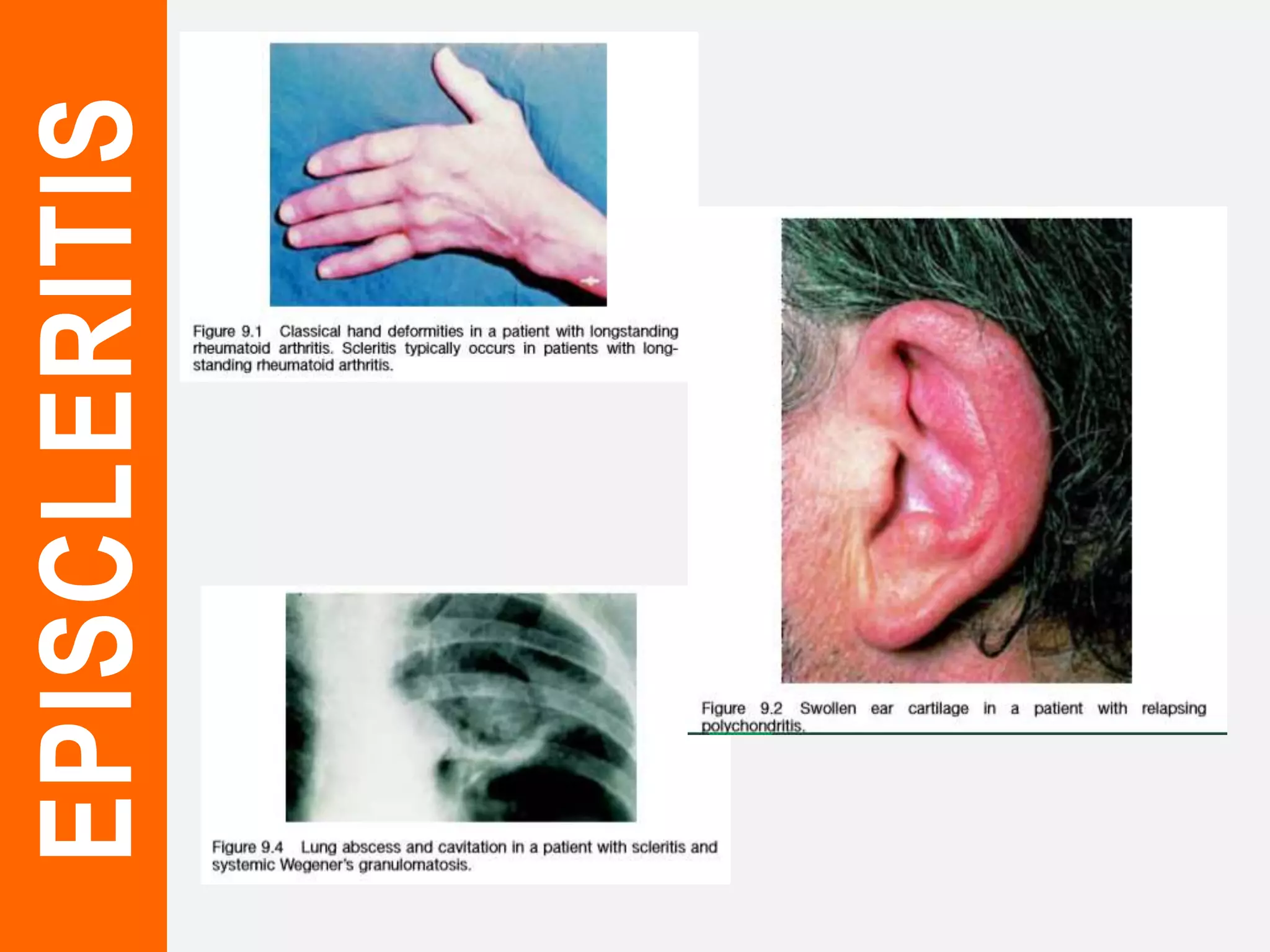 Episcleritis and scleritis | PPTX