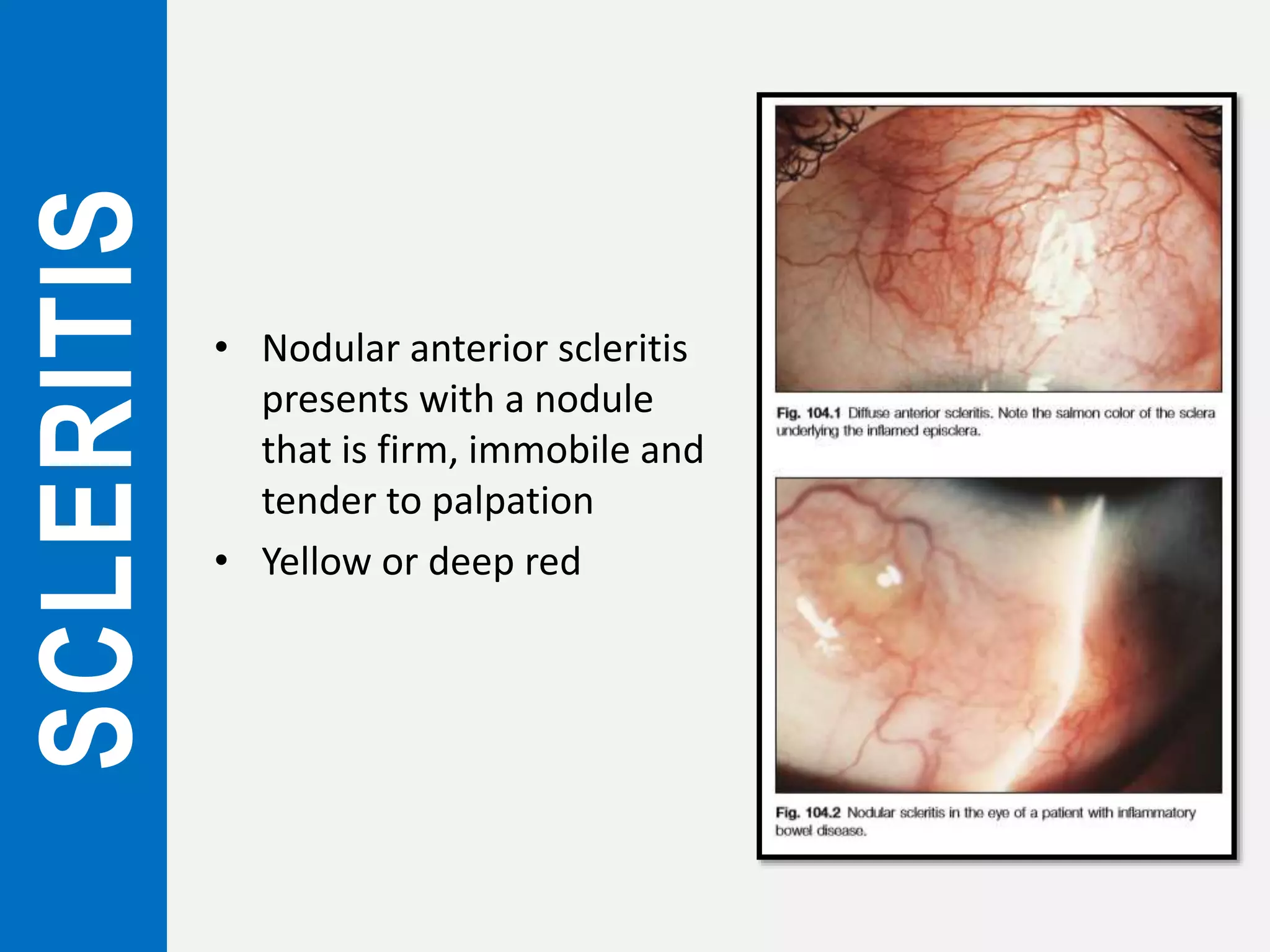 Episcleritis and scleritis | PPTX