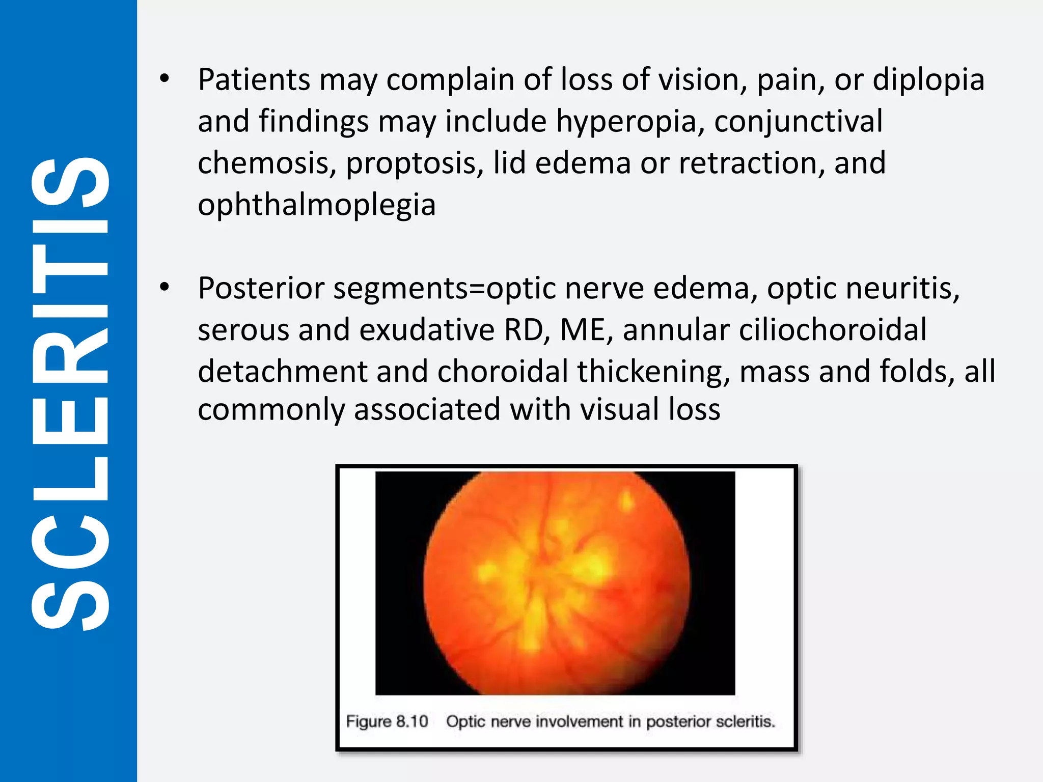 Episcleritis and scleritis | PPTX | Eye and Vision Conditions | Diseases and Conditions