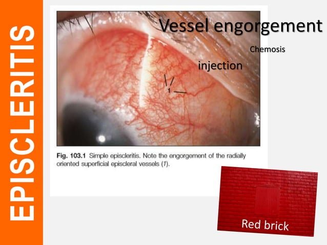 Episcleritis and scleritis | PPTX | Eye and Vision Conditions ...