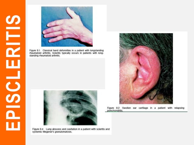 Episcleritis and scleritis | PPTX | Eye and Vision Conditions ...