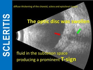 Episcleritis and scleritis | PPTX
