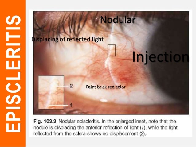 Episcleritis and scleritis