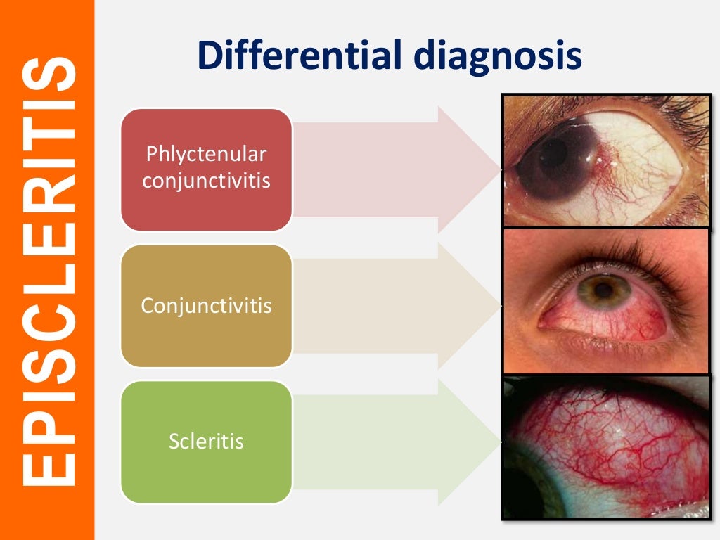 Episcleritis and scleritis