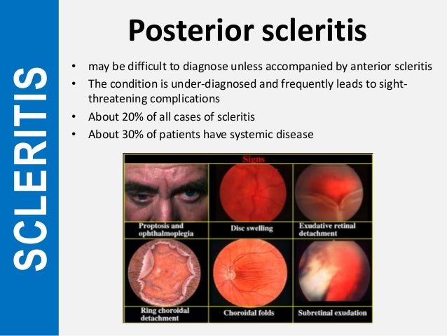 Episcleritis and scleritis