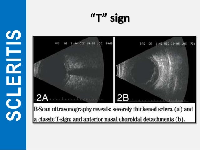 Episcleritis and scleritis