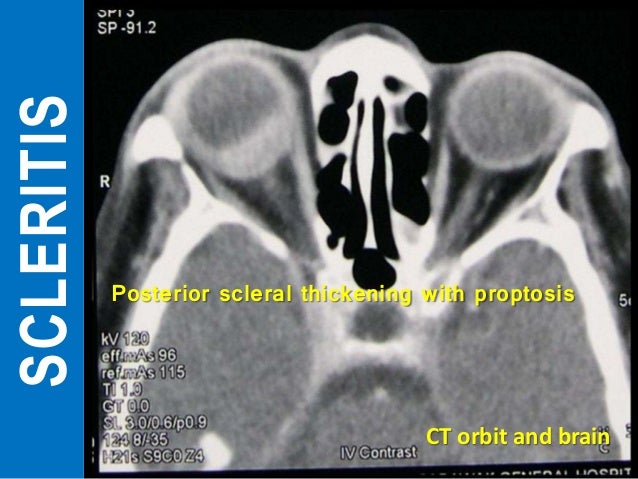 Episcleritis and scleritis