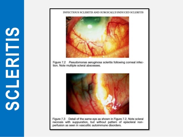 Episcleritis and scleritis