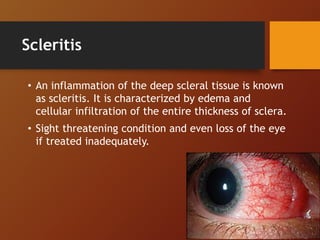 Episcleritis and scleritis.ppt