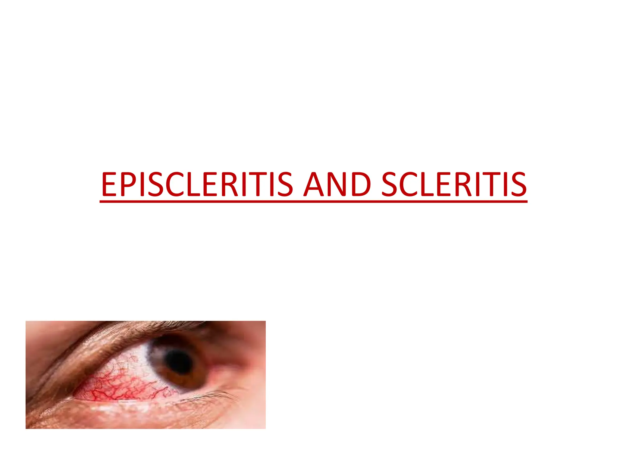 EPISCLERITIS AND SCLERITIS.pptx bbbbbbbb | PPTX