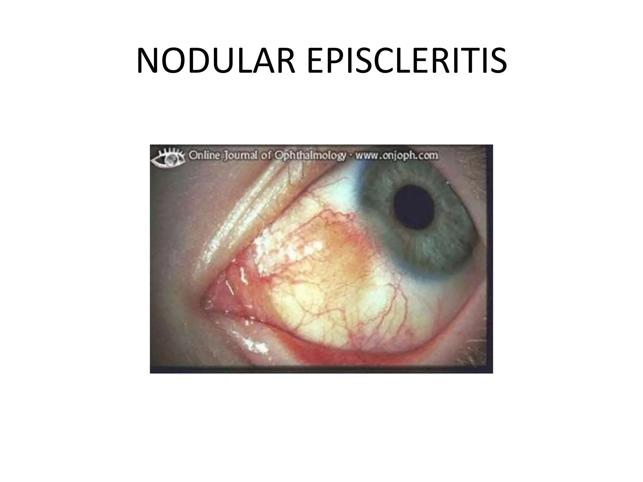 EPISCLERITIS AND SCLERITIS.pptx bbbbbbbb | PPTX
