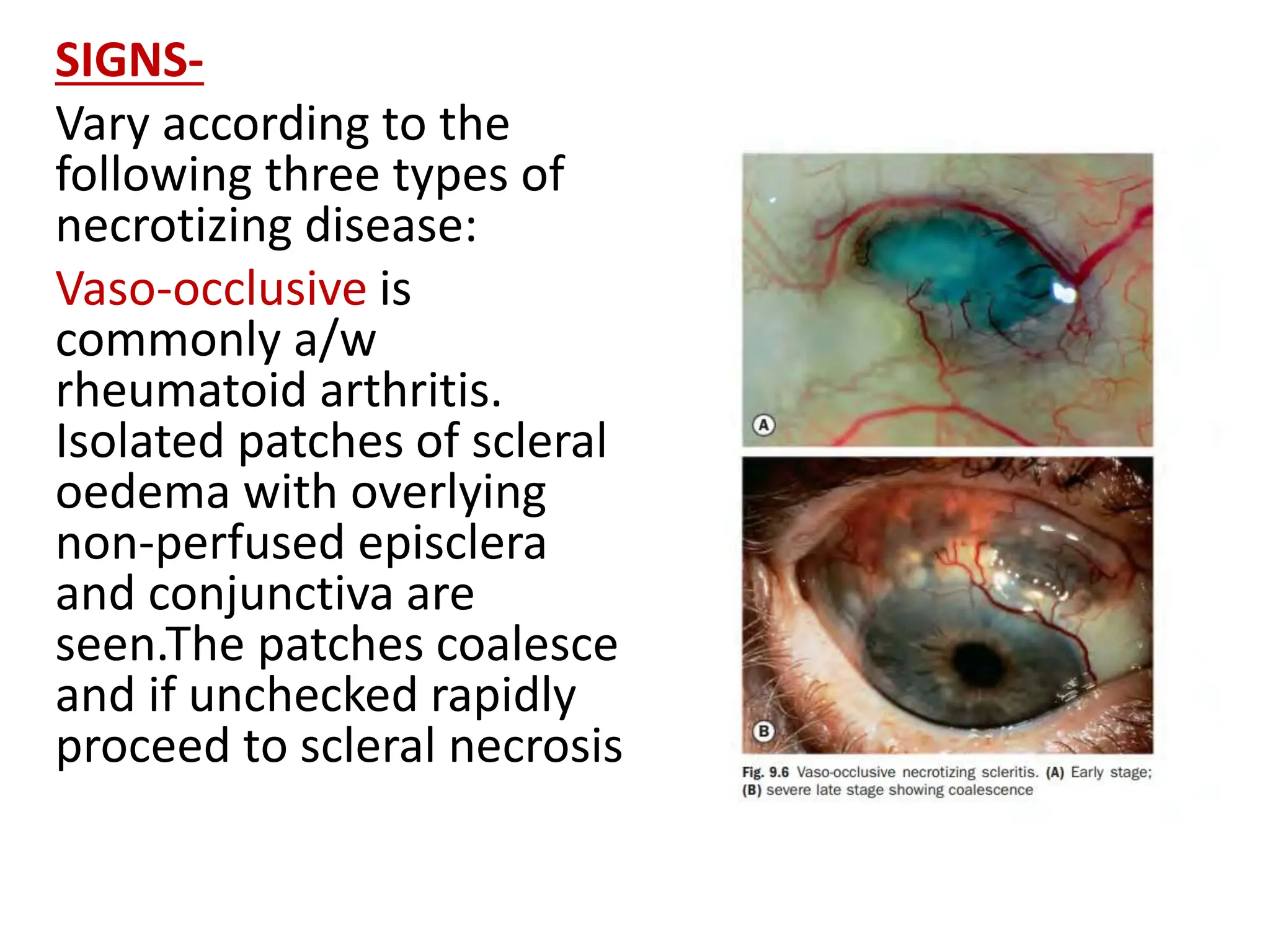 EPISCLERITIS AND SCLERITIS.pptx bbbbbbbb | PPTX