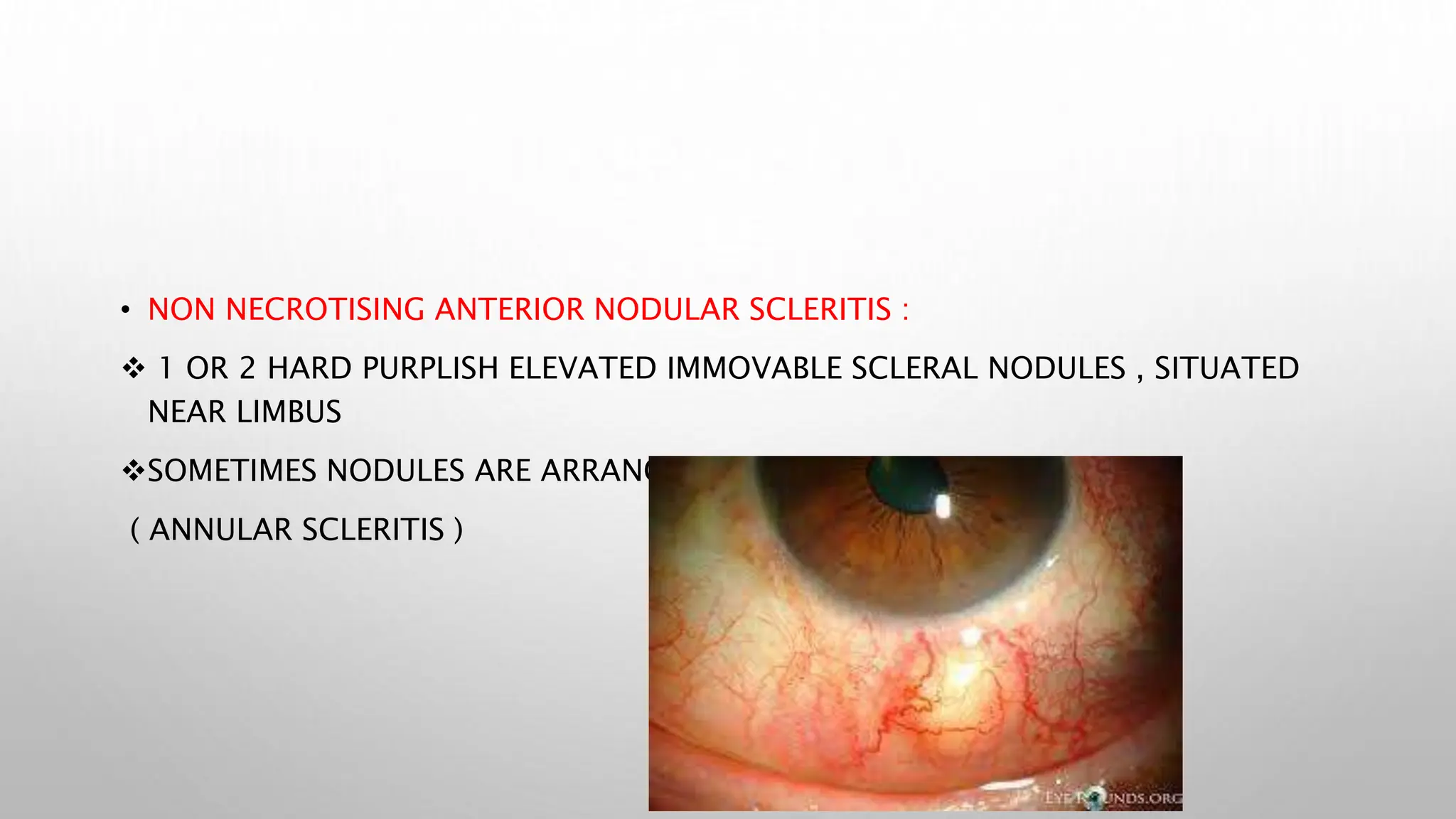 EPISCLERITIS AND SCLERITIS OF THE EYE BALL | PPT