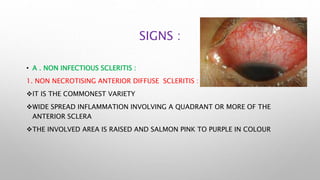 EPISCLERITIS AND SCLERITIS OF THE EYE BALL | PPT