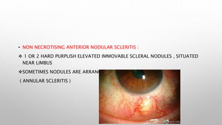 EPISCLERITIS AND SCLERITIS OF THE EYE BALL | PPT