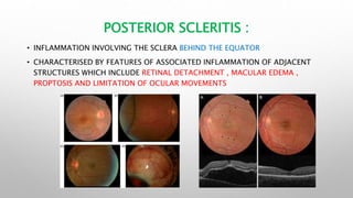 EPISCLERITIS AND SCLERITIS OF THE EYE BALL | PPT