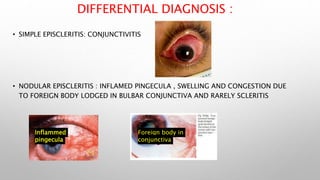 EPISCLERITIS AND SCLERITIS OF THE EYE BALL | PPT