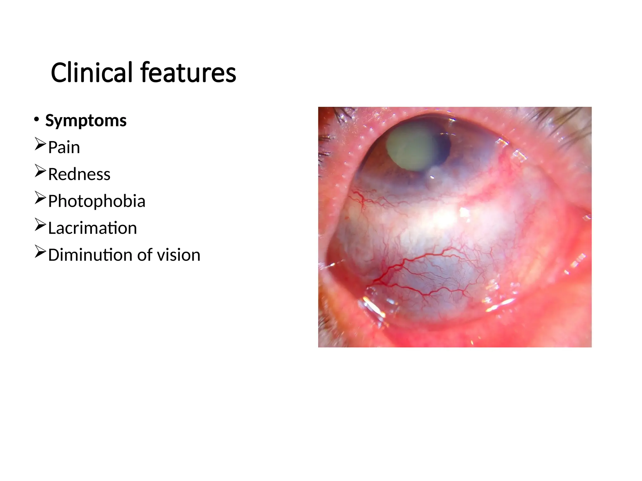 Episcleritis and Scleritis CLASSIFICATION AND MANAGEMENT | PPTX
