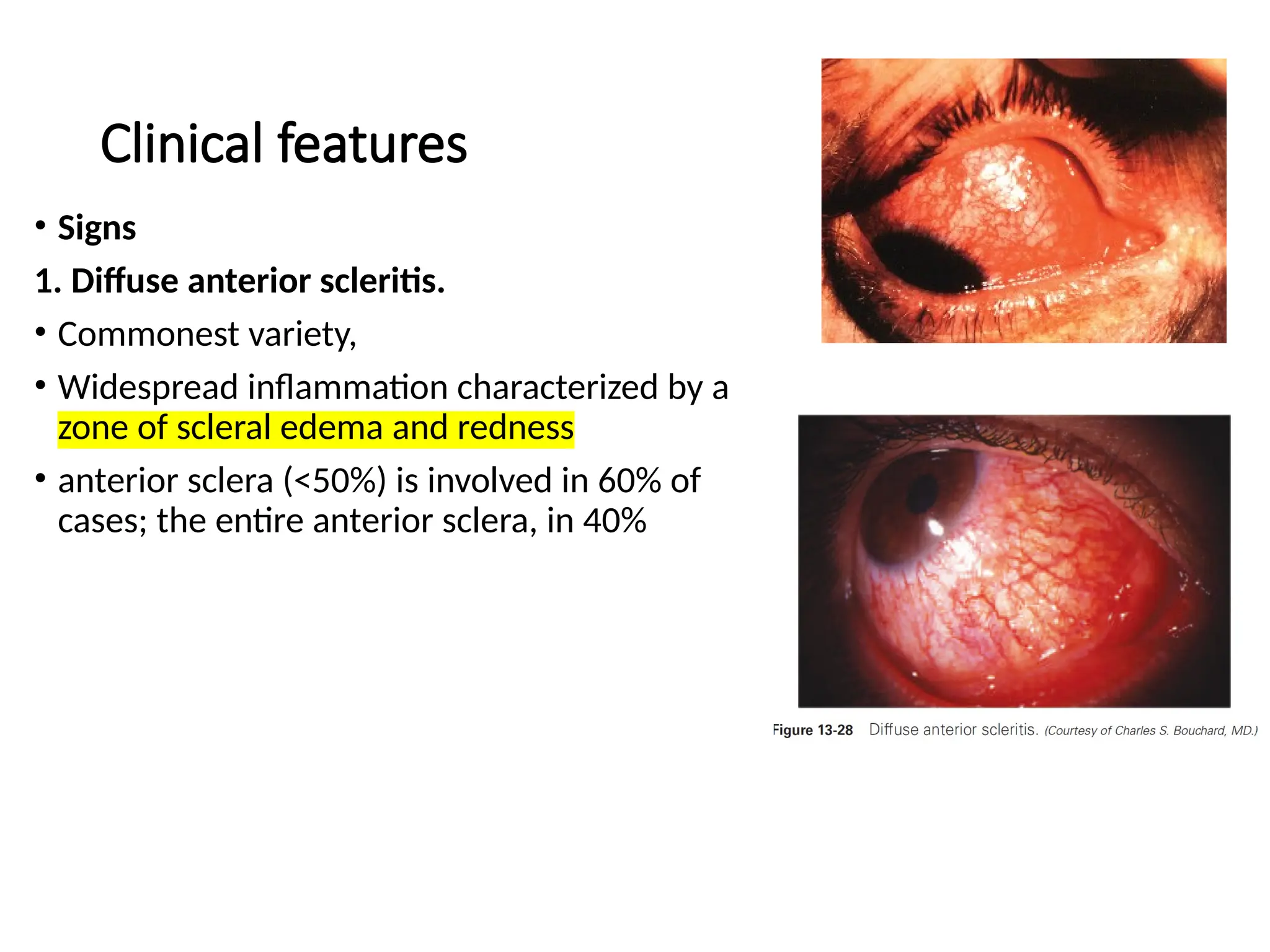 Episcleritis and Scleritis CLASSIFICATION AND MANAGEMENT | PPTX