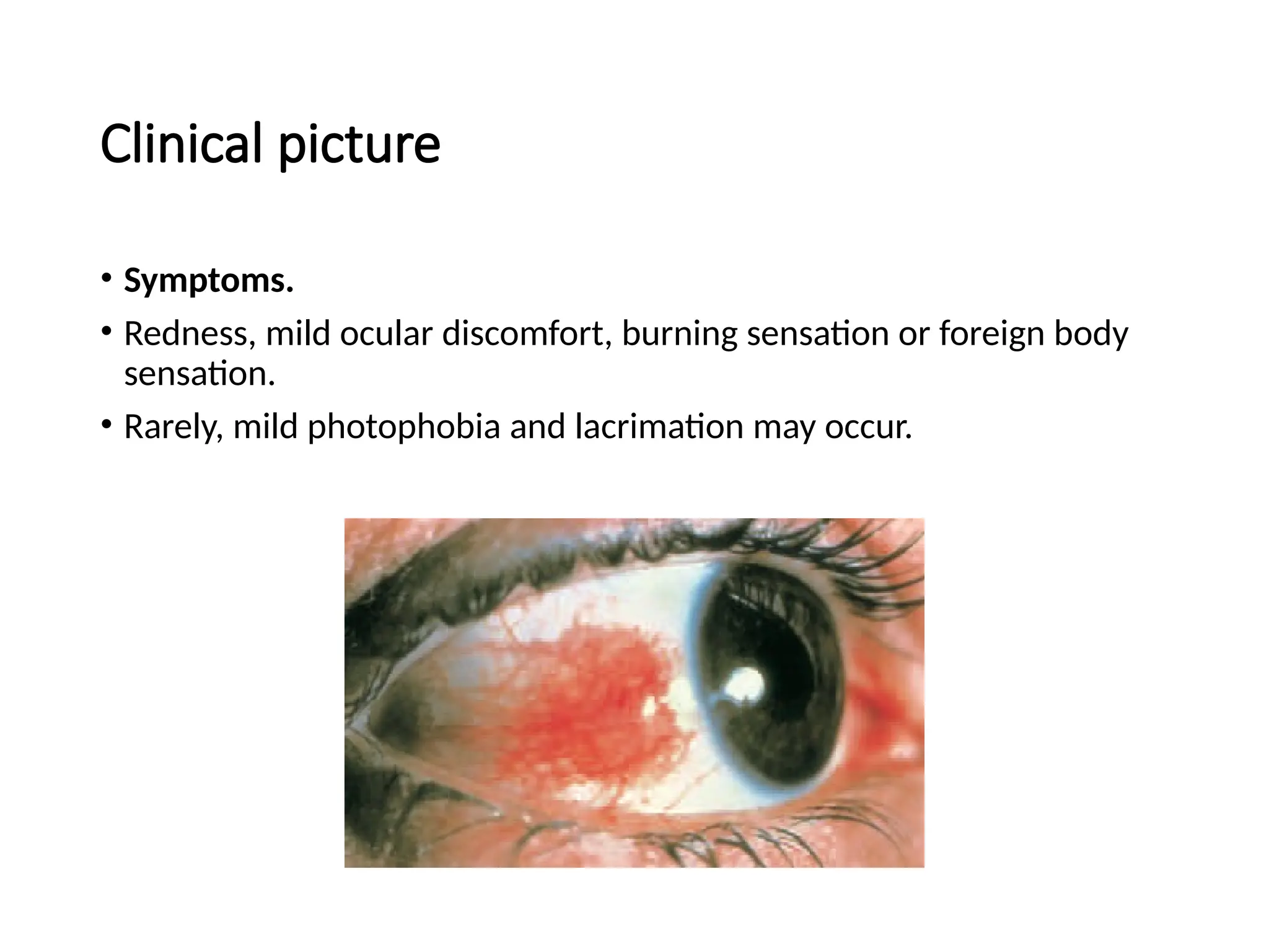 Episcleritis and Scleritis CLASSIFICATION AND MANAGEMENT | PPTX