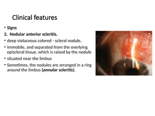Episcleritis and Scleritis CLASSIFICATION AND MANAGEMENT | PPTX