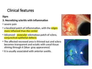 Episcleritis and Scleritis CLASSIFICATION AND MANAGEMENT | PPTX
