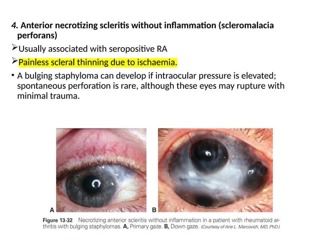 Episcleritis and Scleritis CLASSIFICATION AND MANAGEMENT | PPTX