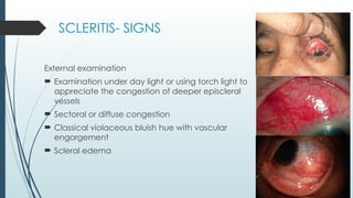 EPISCLERITIS AND SCLERITIS- PRESENTATION.pptx