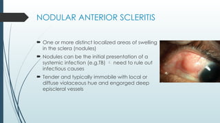EPISCLERITIS AND SCLERITIS- PRESENTATION.pptx