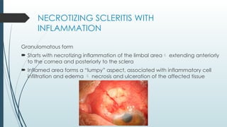 EPISCLERITIS AND SCLERITIS- PRESENTATION.pptx