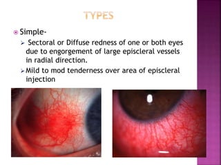 Episcleritis | PPTX