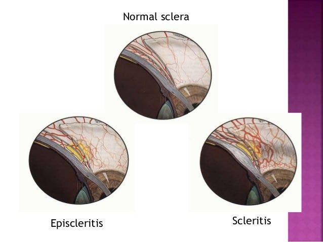 Episcleritis