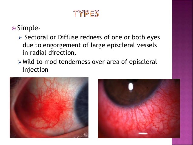 Episcleritis