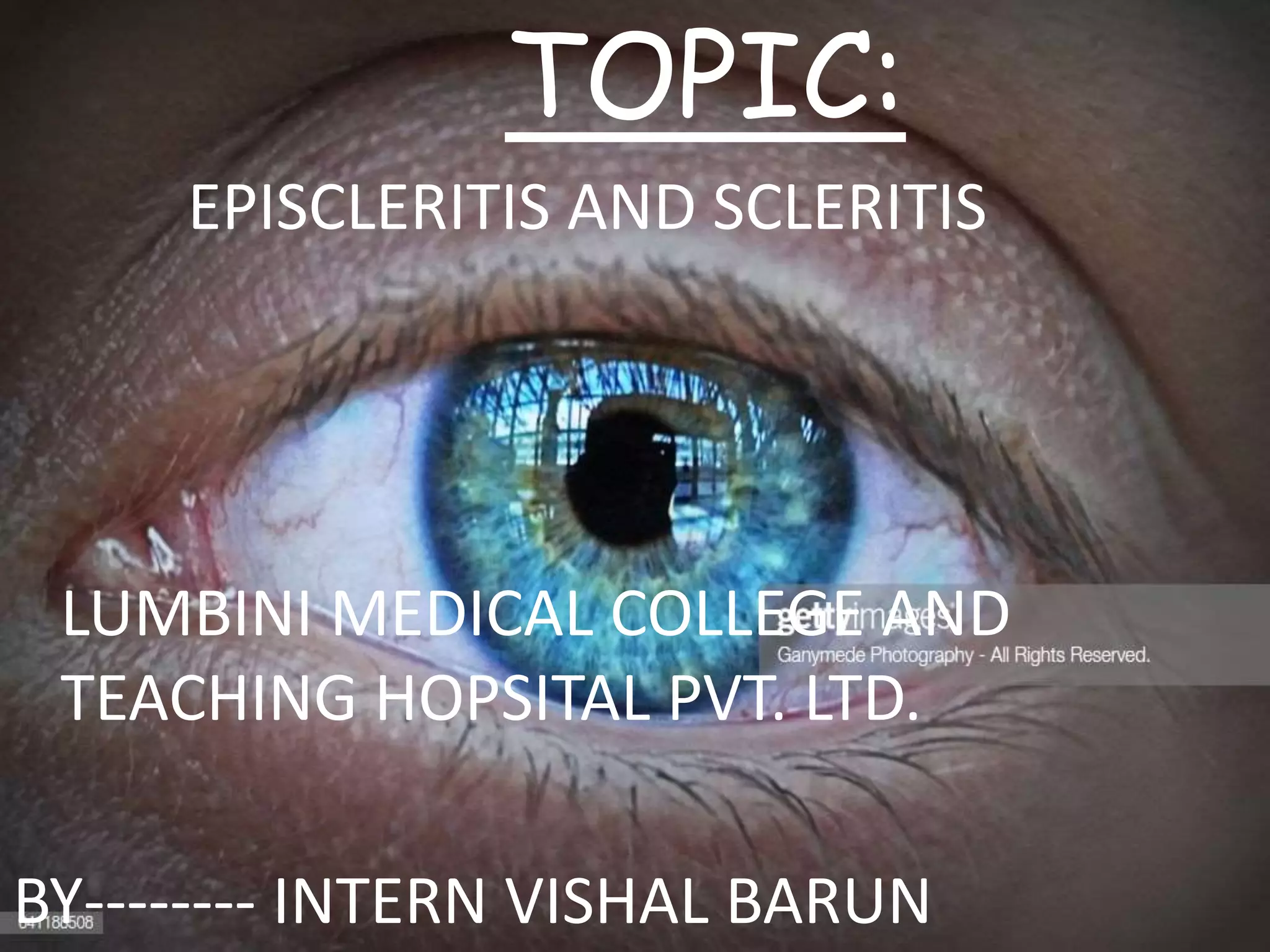 Episcleritis and scleritis (ophthalmology) | PPTX