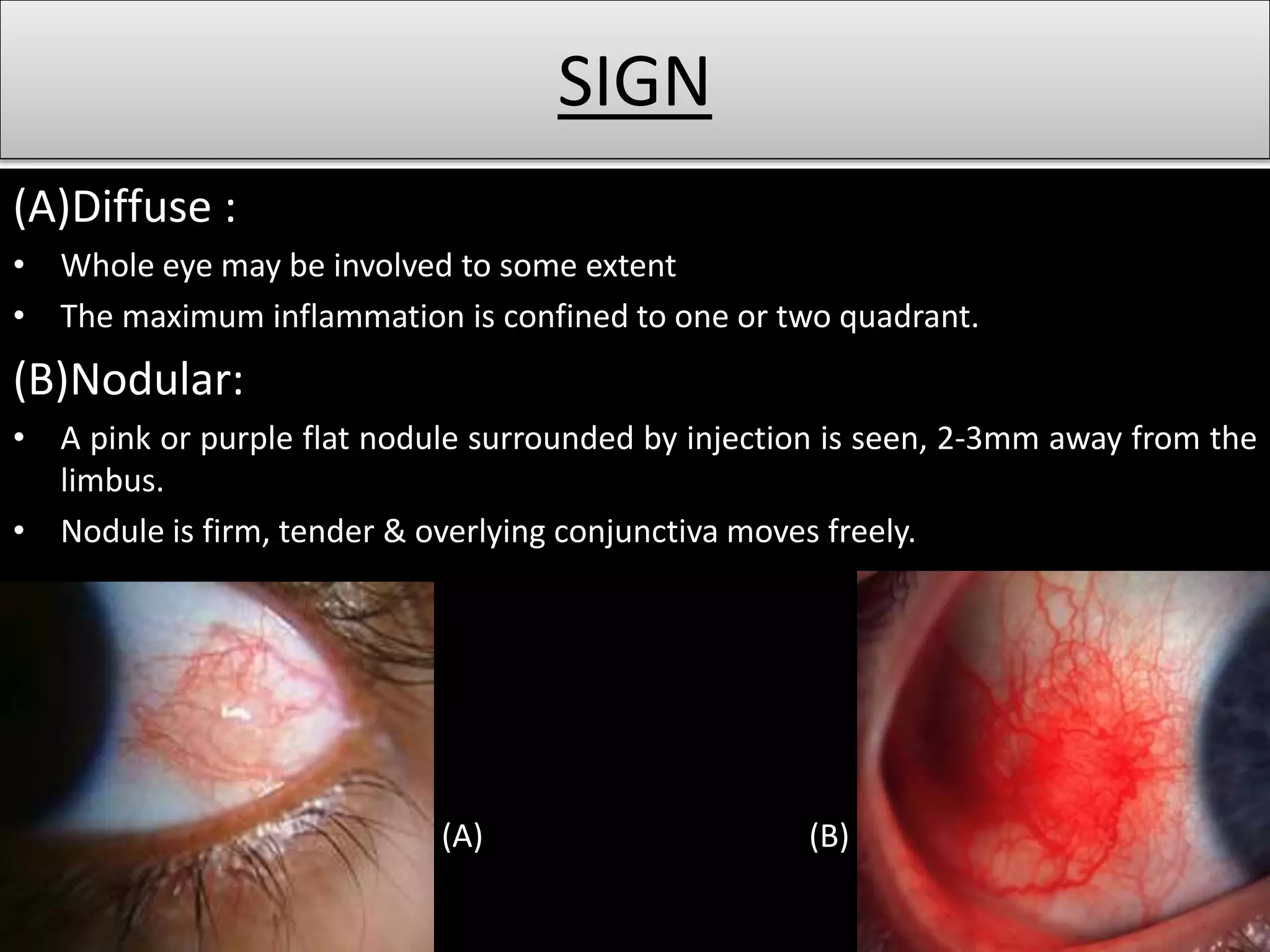 Episcleritis and scleritis (ophthalmology) | PPTX