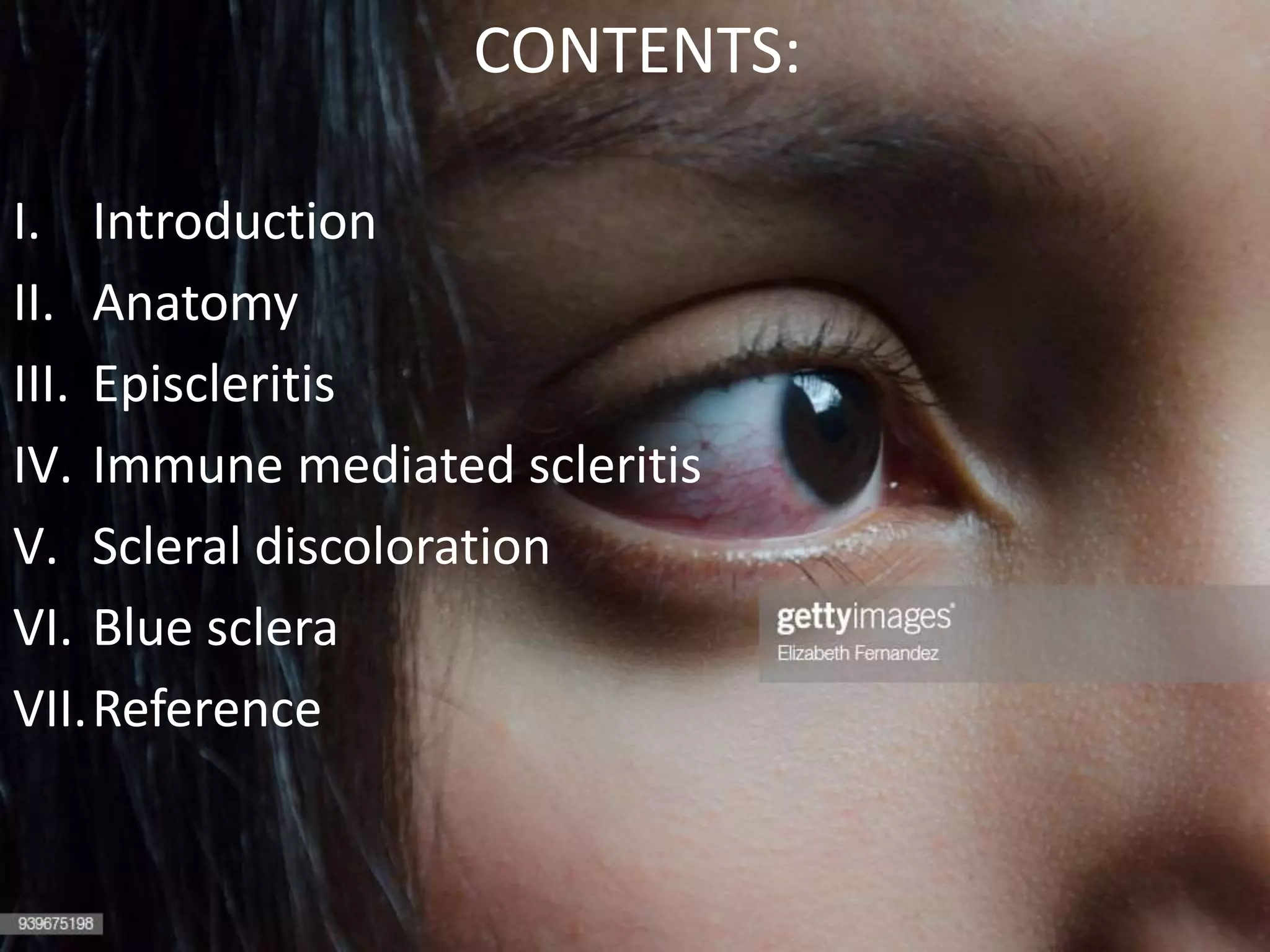Episcleritis and scleritis (ophthalmology) | PPTX