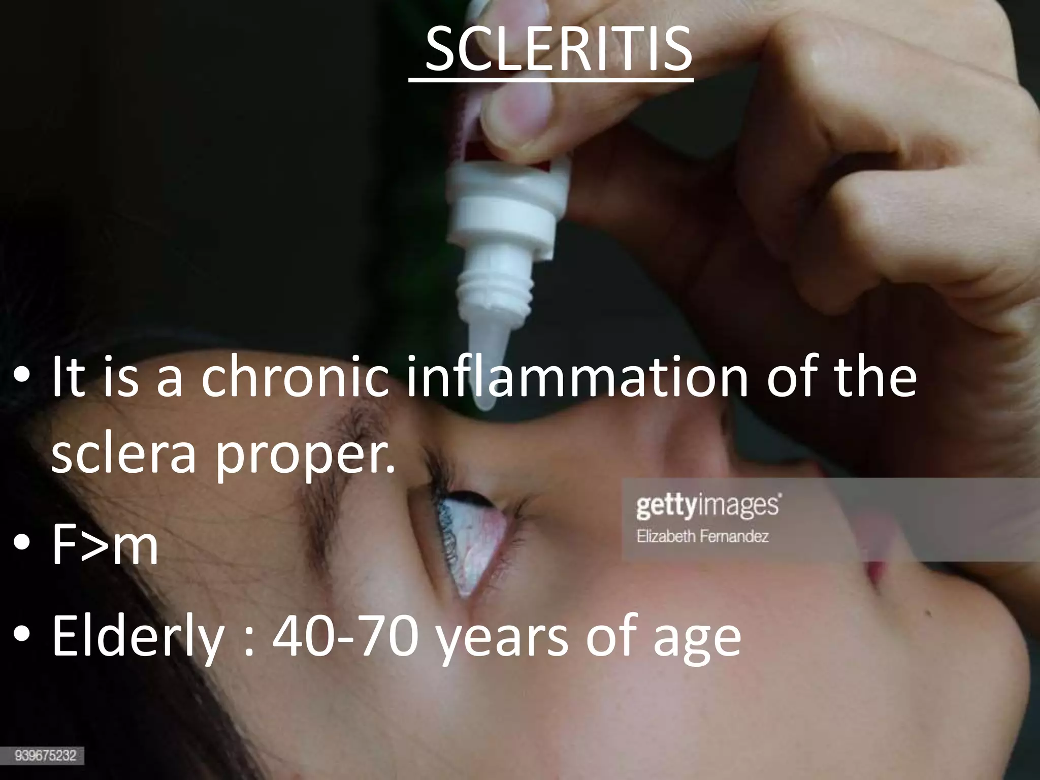 Episcleritis and scleritis (ophthalmology) | PPTX