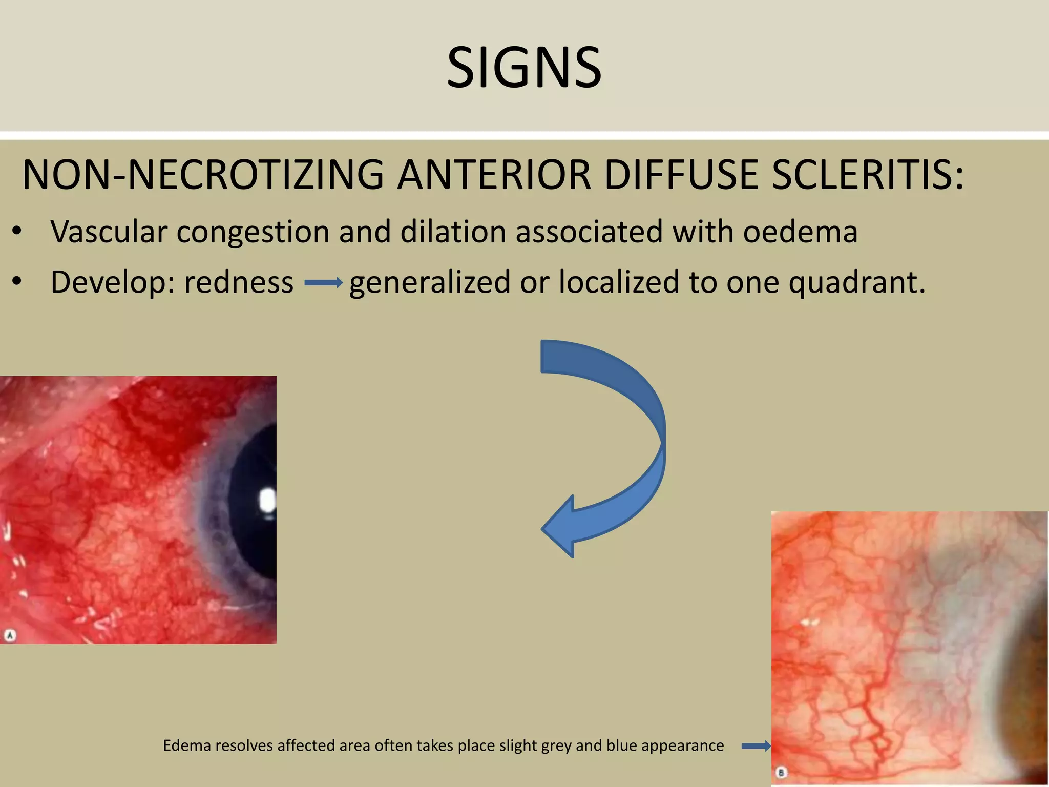Episcleritis and scleritis (ophthalmology) | PPTX