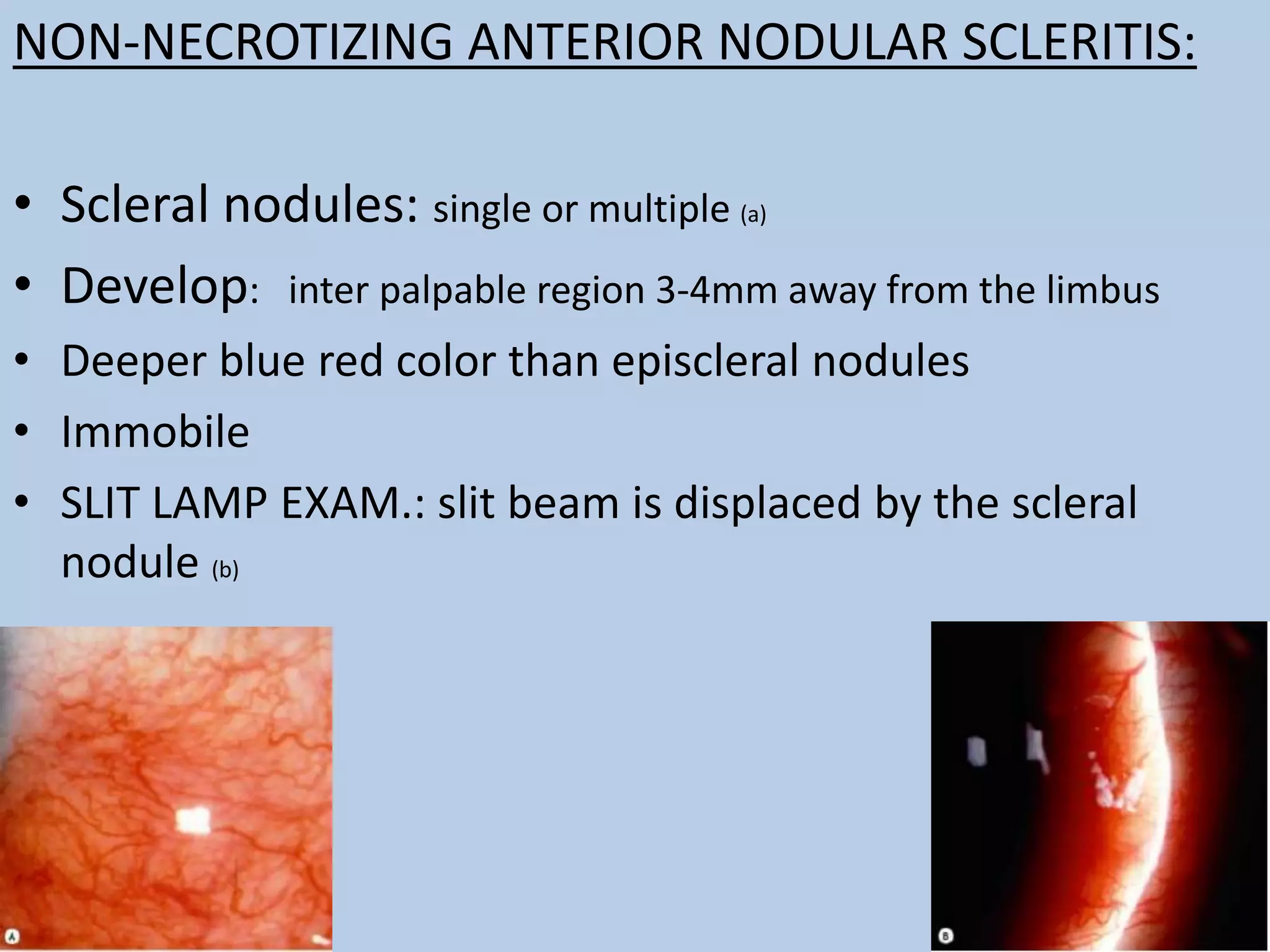Episcleritis and scleritis (ophthalmology) | PPTX