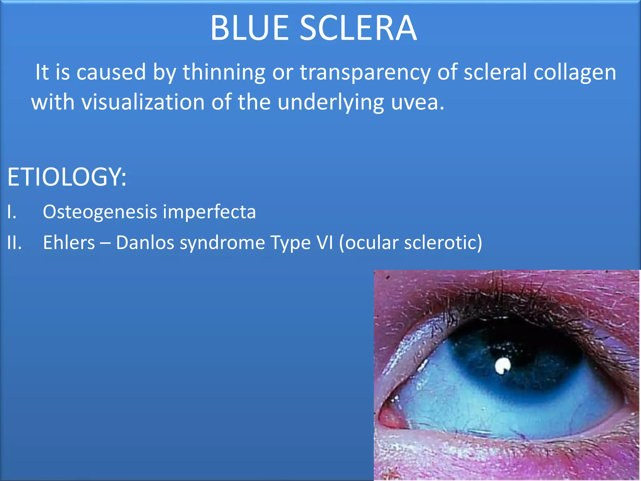 Episcleritis and scleritis (ophthalmology) | PPTX