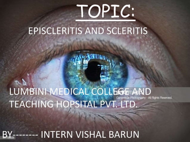 Episcleritis and scleritis (ophthalmology) | PPTX | Eye and Vision ...